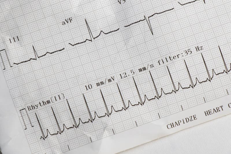 Cardiogram, Waves of Heart Beat, EKG on the Paper Stock Photo - Image ...