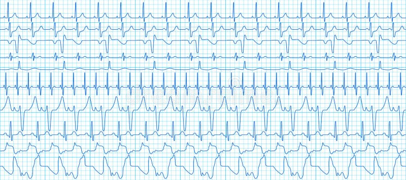 Cardiograms stock vector. Illustration of graph, health - 46521409