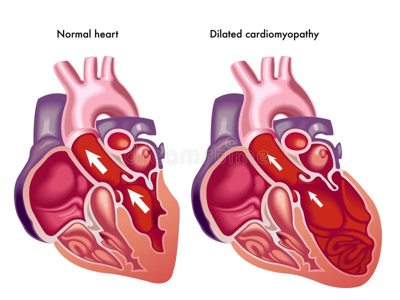 Cardiomiopatía Hipertrófica Del Problema Del Corazón Ilustración del ...
