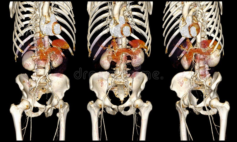 Cardiovascular System on Computed Tomography Stock Image - Image of ...