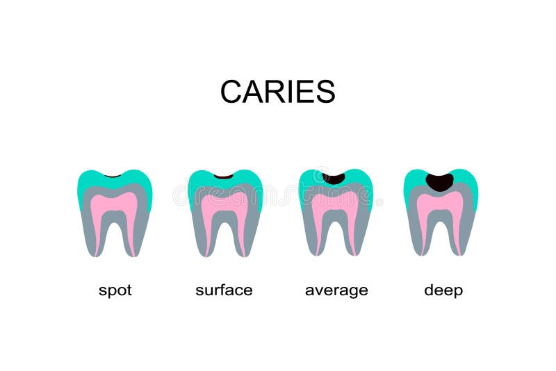 Caries Classification Spor Surface Average Deep Cavity Hand Drawn ...