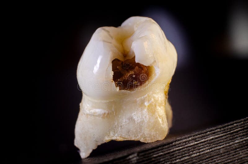 Caries on a Human Tooth on a Dark Background Stock Photo - Image of ...