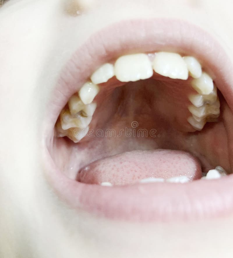 Caries on Milk Upper Chewing Teeth Stock Image - Image of space ...