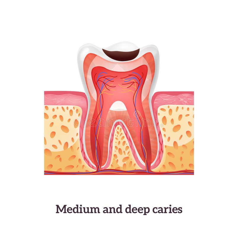 Deep Caries Stock Illustrations – 123 Deep Caries Stock Illustrations ...