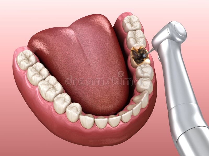 Caries Removing Process Medically Accurate Tooth Illustration Stock