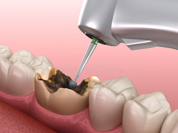 Caries Removing Process. Medically Accurate Tooth 3D Illustration Stock ...