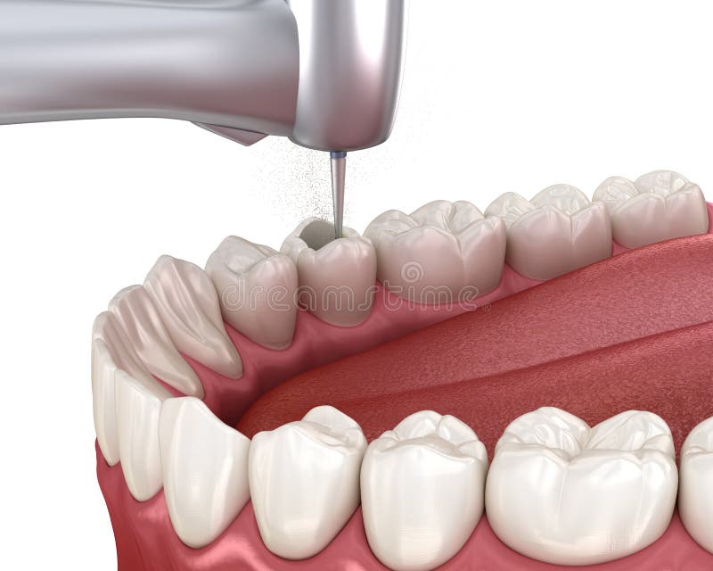 Caries Removing Process. Medically Accurate Tooth 3D Illustration Stock ...