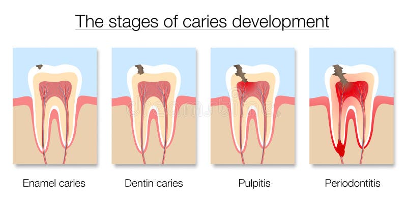 Caries Stages Development Tooth Decay Cross Sections Stock Vector ...
