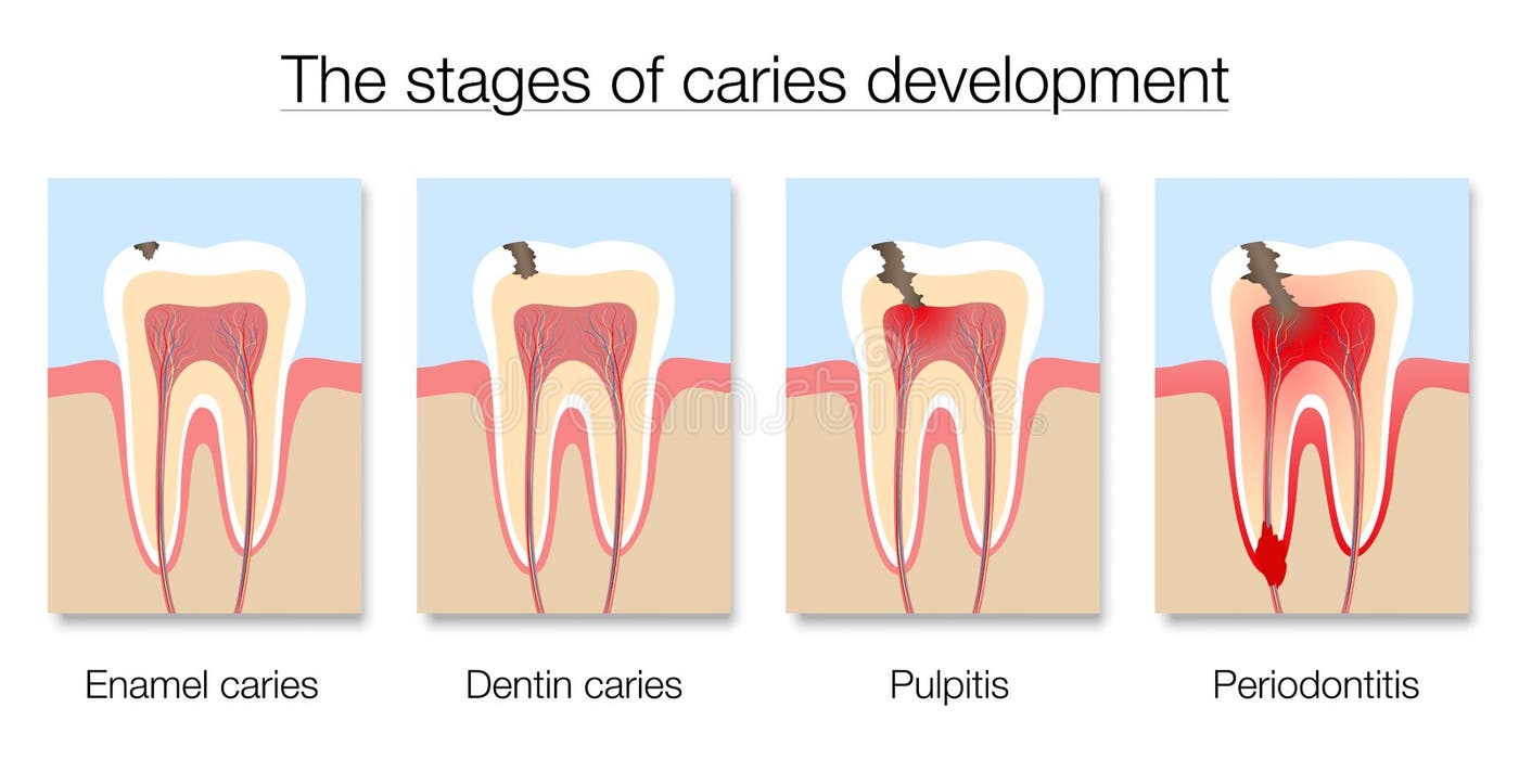 Stages Caries Development Stock Illustrations – 53 Stages Caries ...