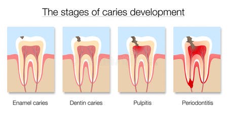 Caries Stages Development Tooth Decay Cross Sections Stock Vector ...