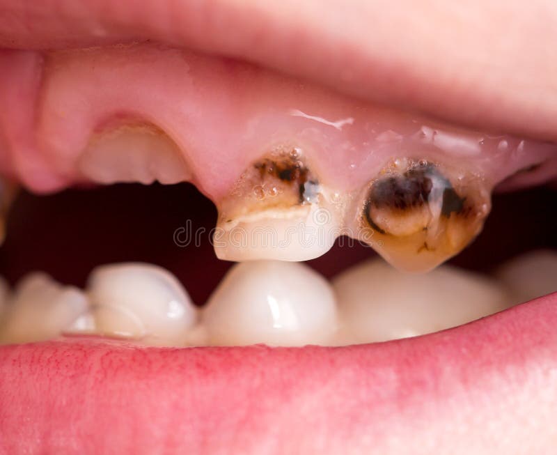 Caries on teeth stock photo. Image of clinic, face, decay - 101050682
