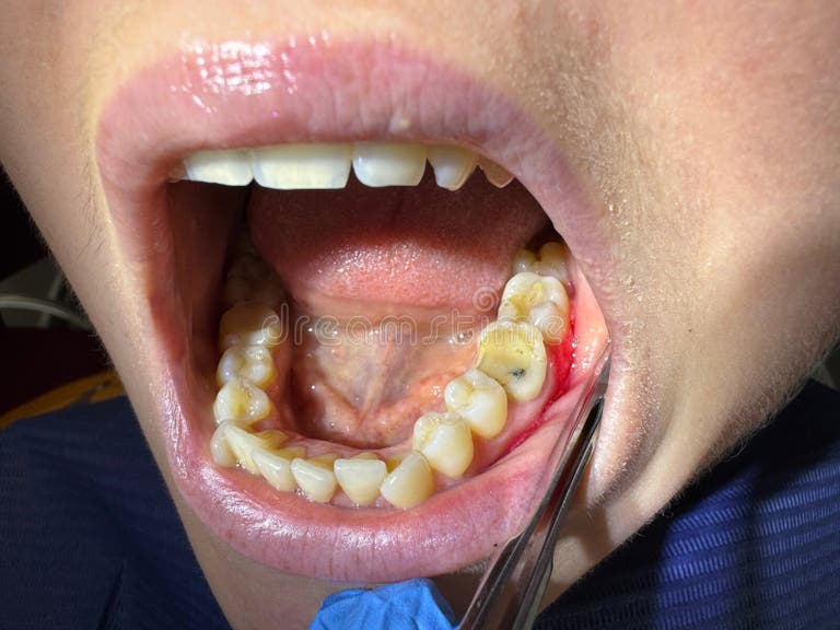 Caries Treatment Using a Matrix System — Dental Restoration Procedure ...