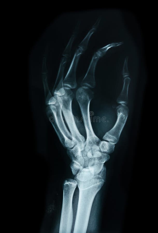 Carpal bones Human X Ray. stock image. Image of medical - 99024907