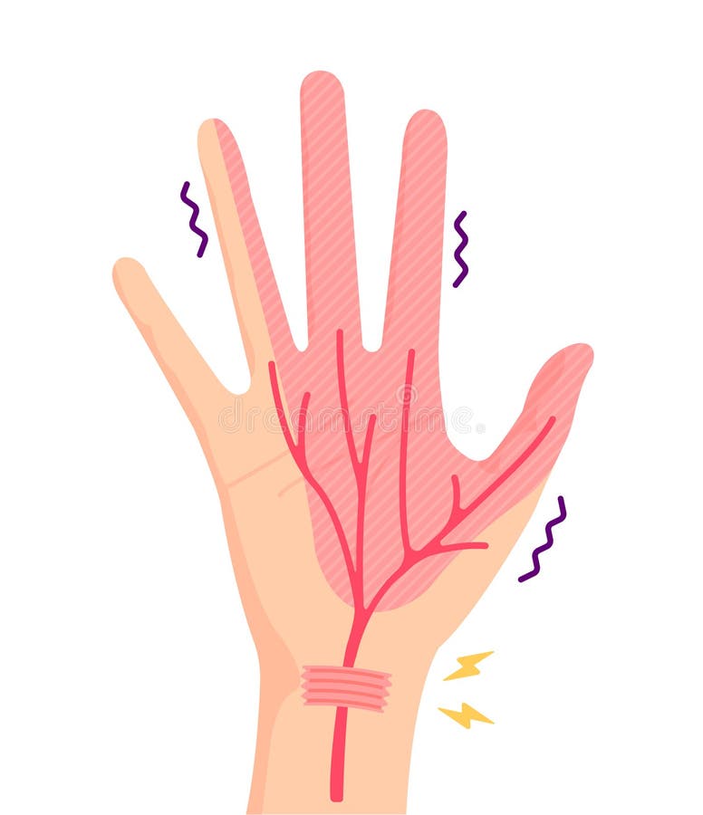 Carpal Tunnel Syndrome Illustration Stock Vector - Illustration of ...