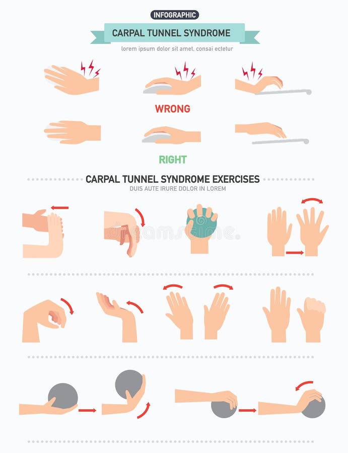 Carpal Tunnel Syndrome Infographic Stock Vector - Illustration of ...