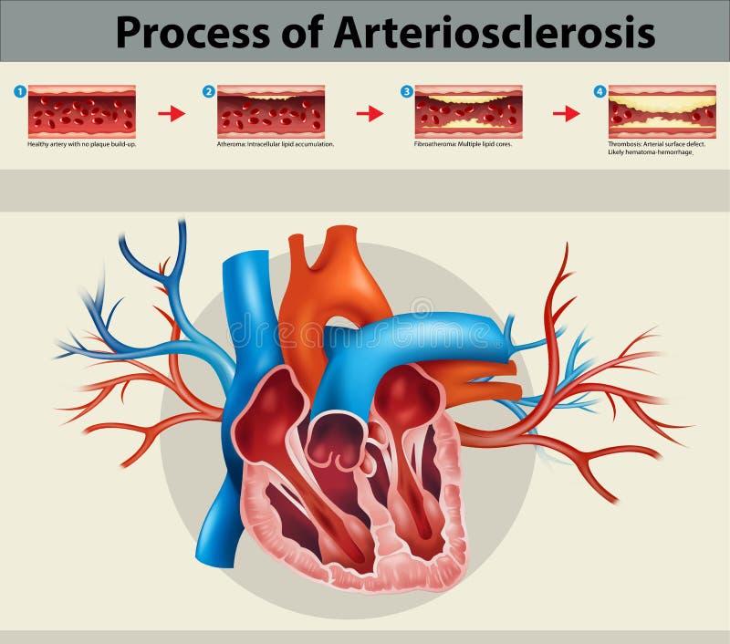 Processo De Cartaz Da Arteriosclerose Ilustração do Vetor - Ilustração ...