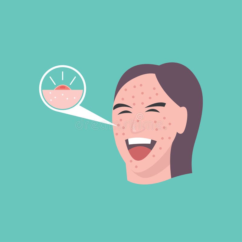 Cartoon Women with Acne Facial Problems Vector Element Design Stock ...