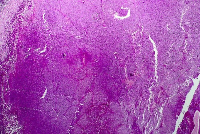 Caseous Necrosis Lymph Node