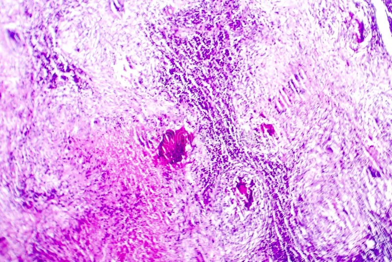 Caseous Necrosis of Lymphatic Node Stock Photo - Image of lymphatic ...