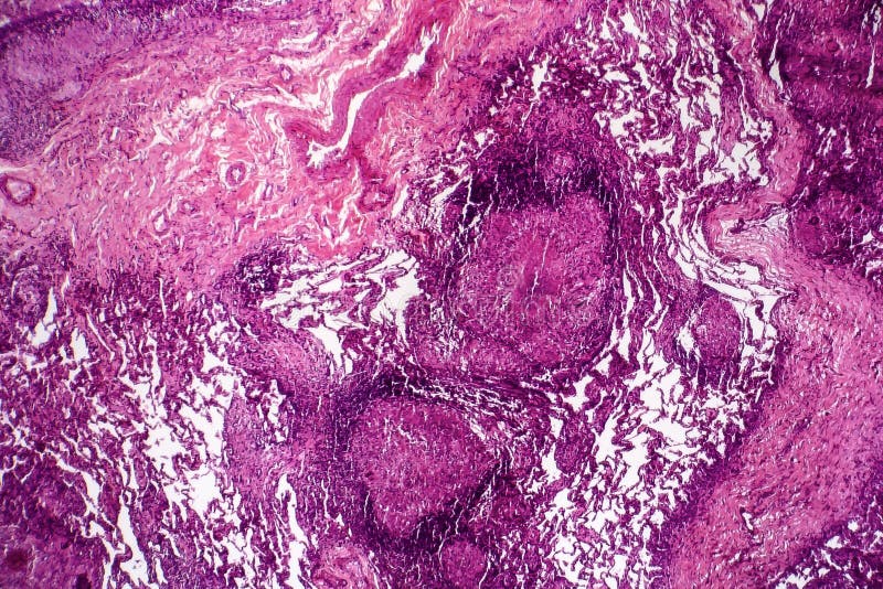 Caseous Pneumonia, Light Micrograph Stock Image - Image of medical ...