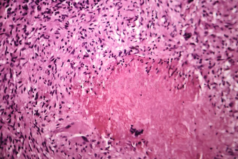 Caseous Pneumonia, Light Micrograph Stock Image - Image of ...