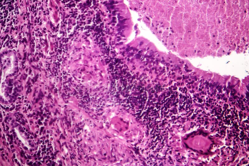 Caseous Pneumonia, Light Micrograph Stock Photo - Image of ...