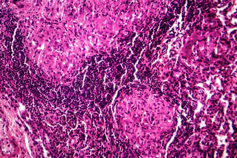 Caseous Pneumonia, Light Micrograph Stock Photo - Image of pathogen ...