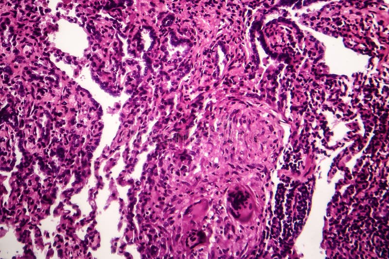 Caseous Pneumonia, Light Micrograph Stock Photo - Image of morphology ...