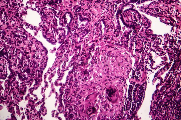 Caseous Pneumonia, Light Micrograph Stock Photo - Image of morphology ...