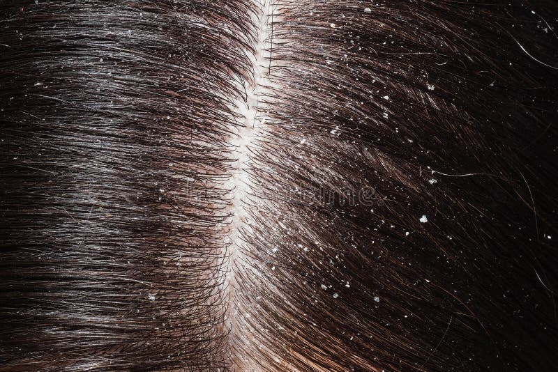 Caspa em seu cabelo escuro foto de stock. Imagem de sebum - 68125136