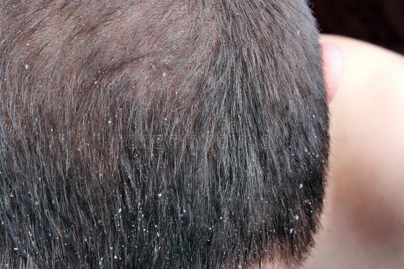 Caspa en el pelo imagen de archivo. Imagen de muchacho - 75056215
