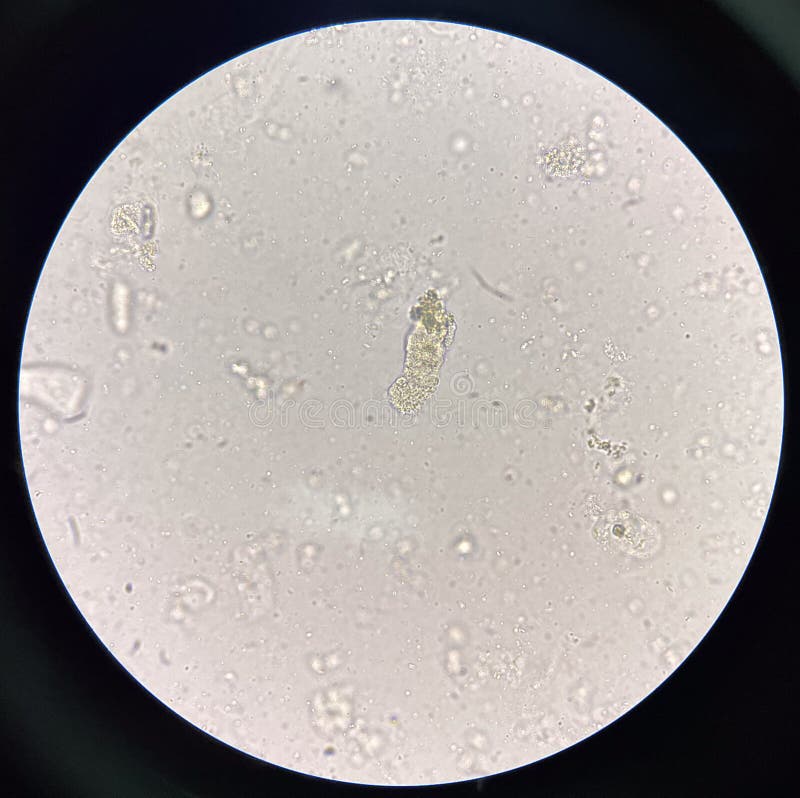 Digital Images Of Cast In Urine