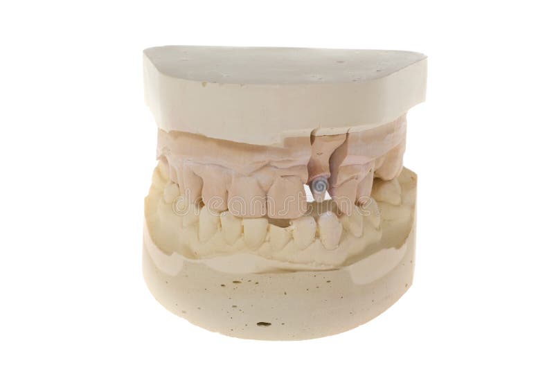Dental Impressions stock image. Image of orthdontics, gums - 13553