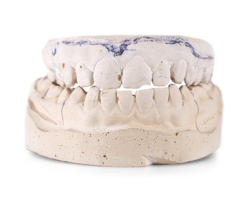 Cast of the Jaw of the Teeth from Plaster Isolated on White Stock Photo ...