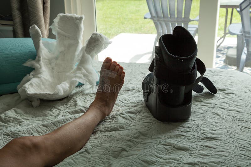 Cast Removed from a Foot after Bunion Surgery Stock Image - Image of ...