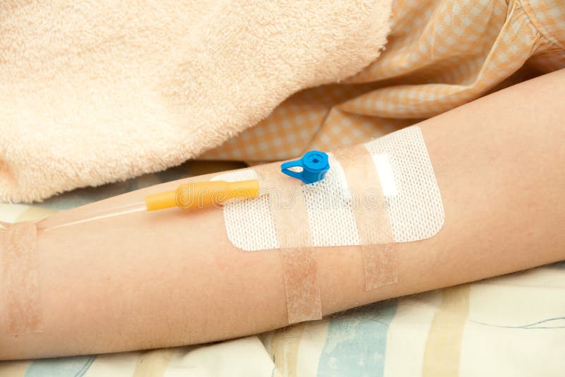 Mano Con El Catéter En Vena Imagen de archivo - Imagen de vena ...