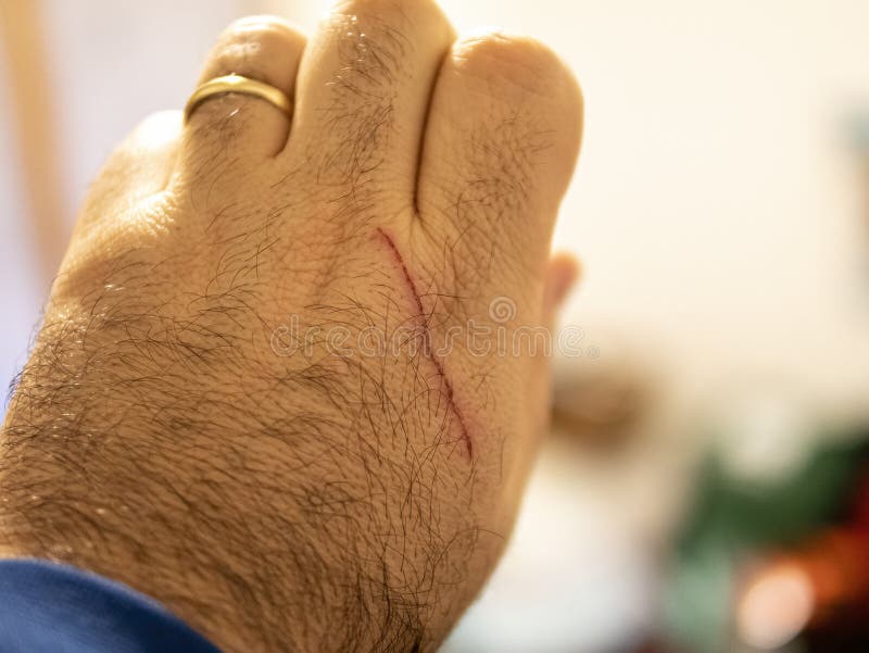 A Scratch on the Human Body. Scar Close-up Stock Photo - Image of ...