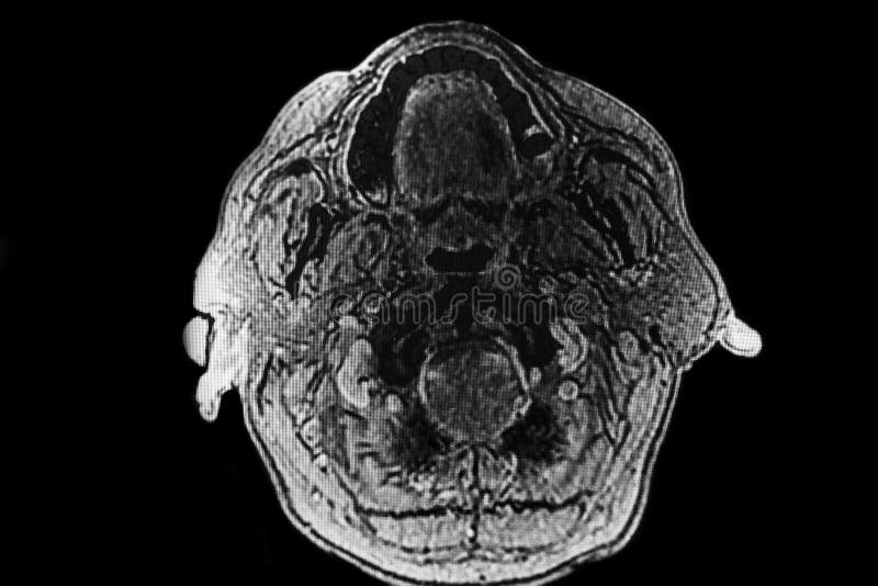 CAT - Scan of brain tumor. stock image. Image of brain - 249404457