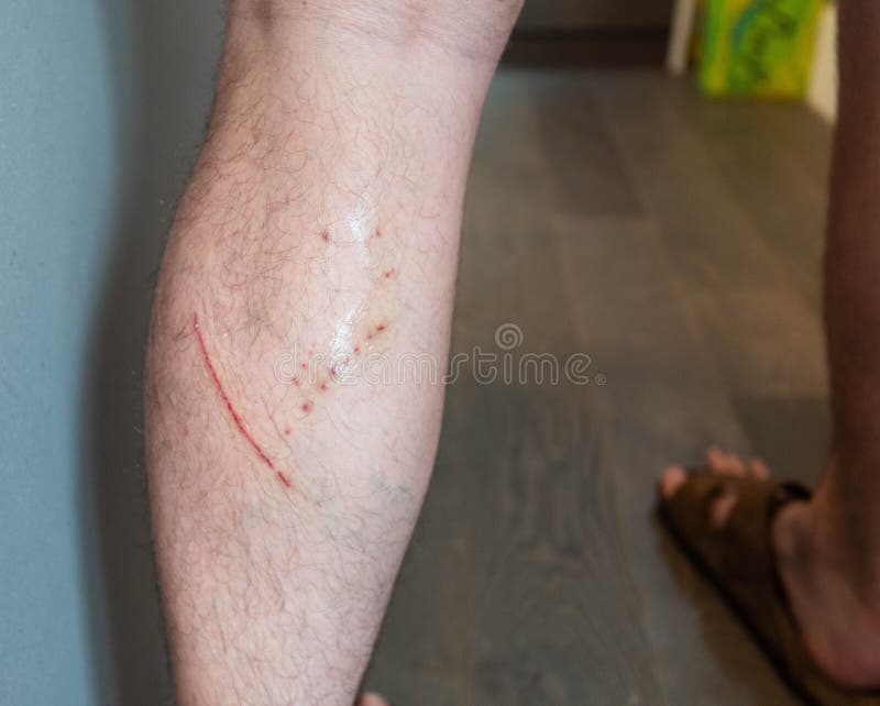Cat Scratches and Claw Marks on Man`s Leg Stock Image - Image of ...