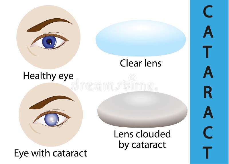 A Cataract is an Clouding Crystalline Lens Inside the Eye. Stock Vector ...