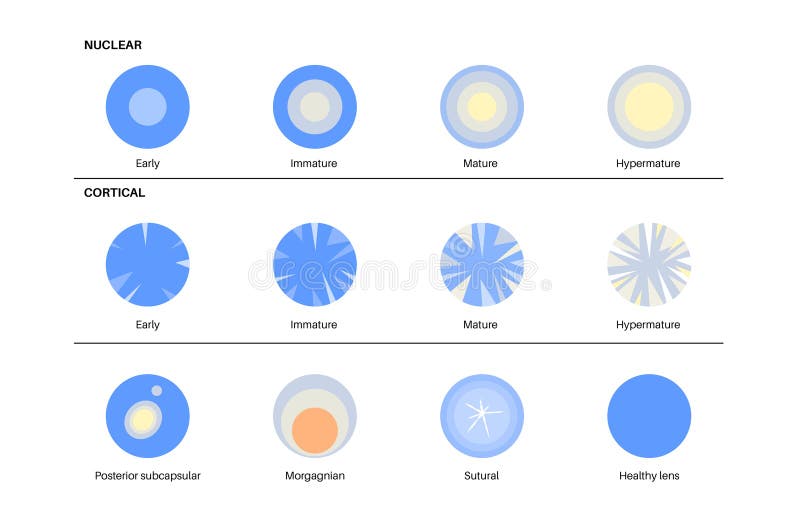 Cataract eye disease stock vector. Illustration of nerve - 326959545