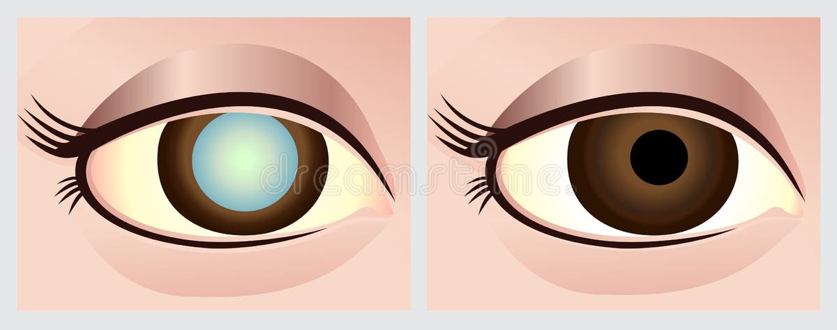 Eye Problem Stock Illustrations – 8,589 Eye Problem Stock Illustrations ...