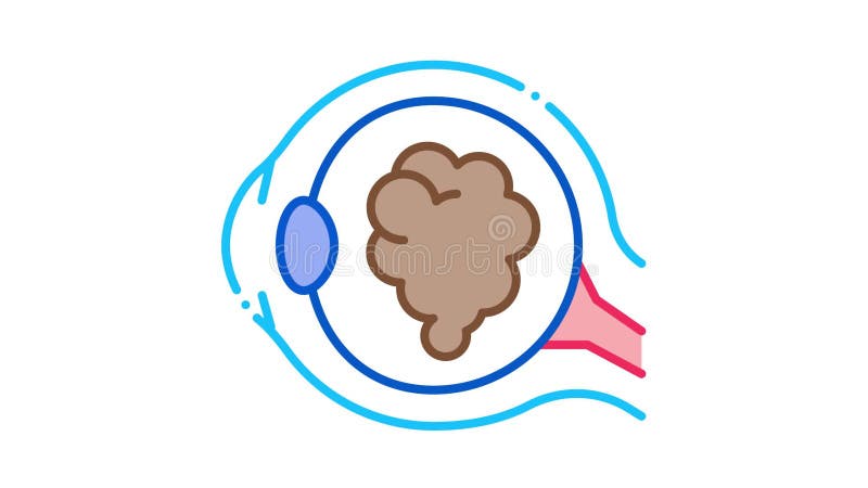Cataract Eyes Icon Animation Stock Footage - Video of medical, surgery ...