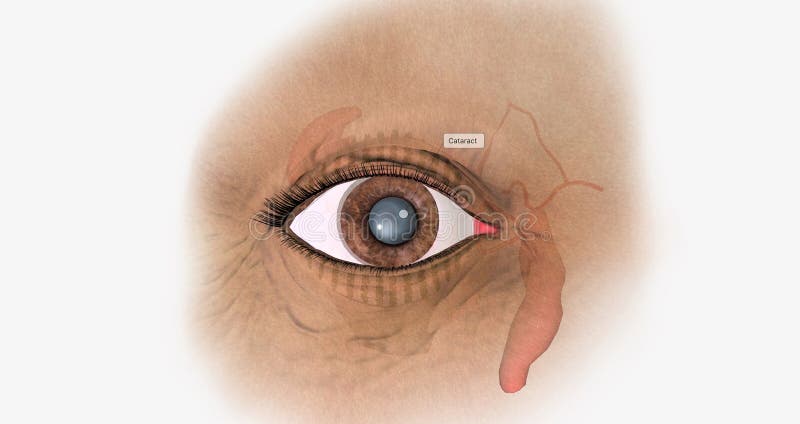 A Cataract is the Progressive Clouding of the Lens of the Eye ...