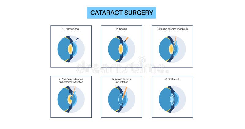 Cataract surgery poster stock vector. Illustration of tweezers - 331308560