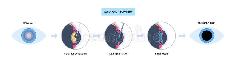 Cataract surgery poster stock vector. Illustration of tweezers - 331308560