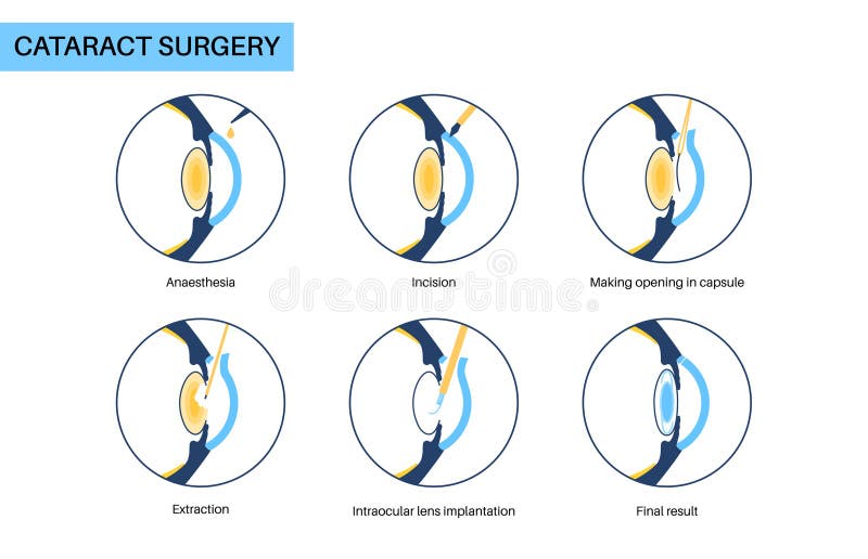 Cataract Extraction Stock Illustrations – 43 Cataract Extraction Stock ...