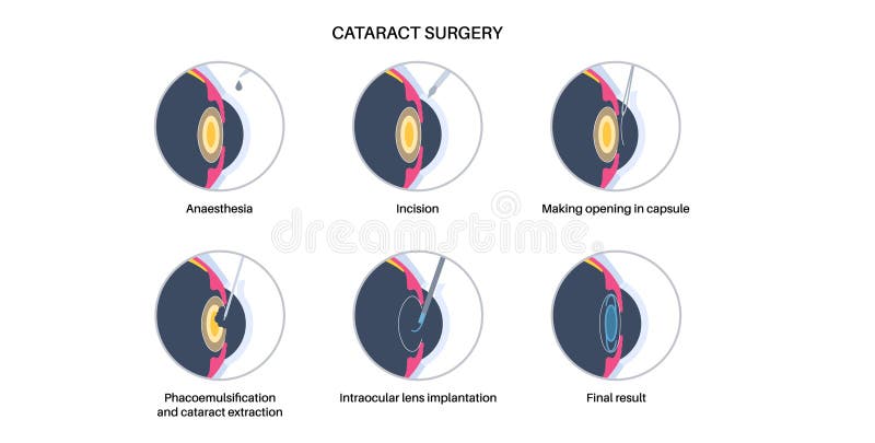 Cataract surgery poster stock vector. Illustration of tweezers - 331308560