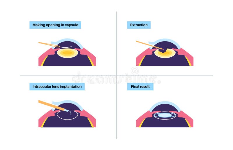 Cataract surgery poster stock vector. Illustration of blindness - 331577937