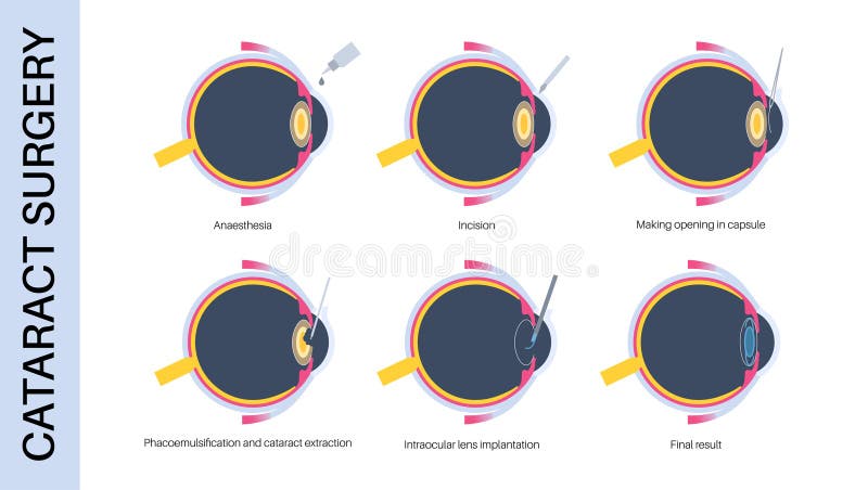 Cataract surgery poster stock vector. Illustration of implant - 331729958